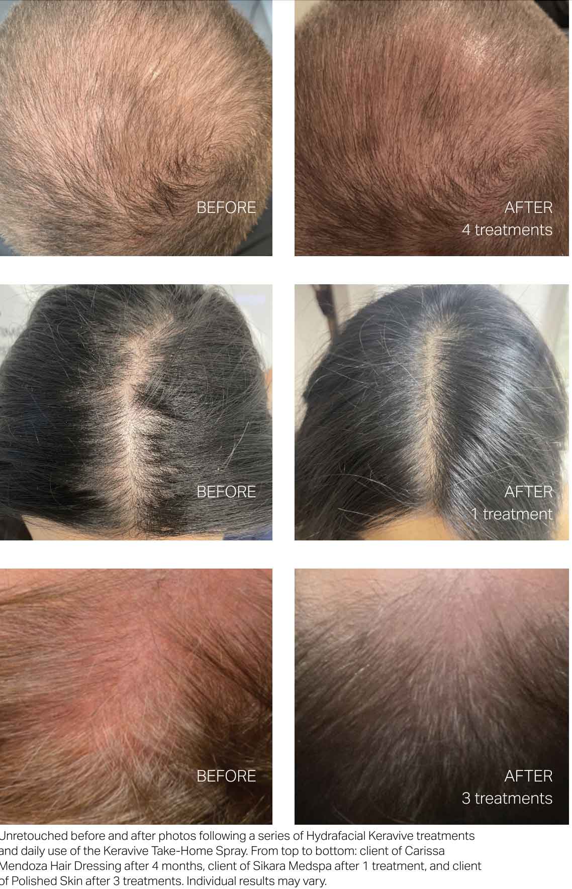 Hydrafacial Keravive™ Scalp - Rebecca Fitzgerald