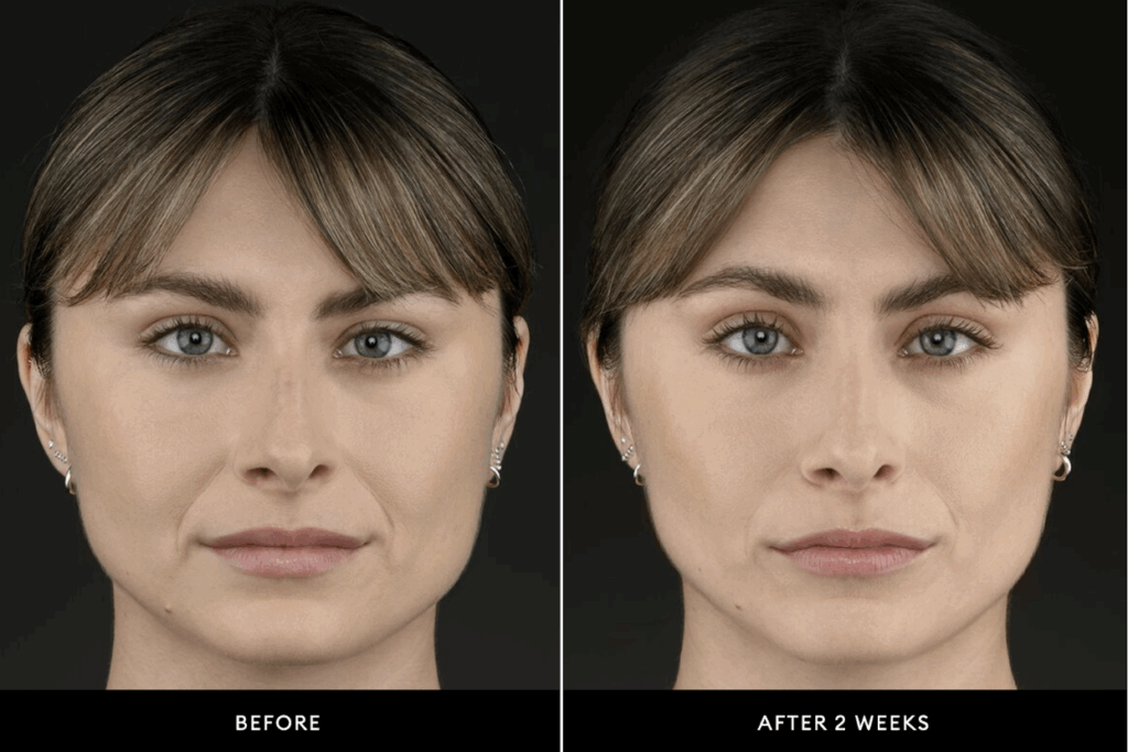 Evolysse in Los Angeles | Hylauronic Gel Filler